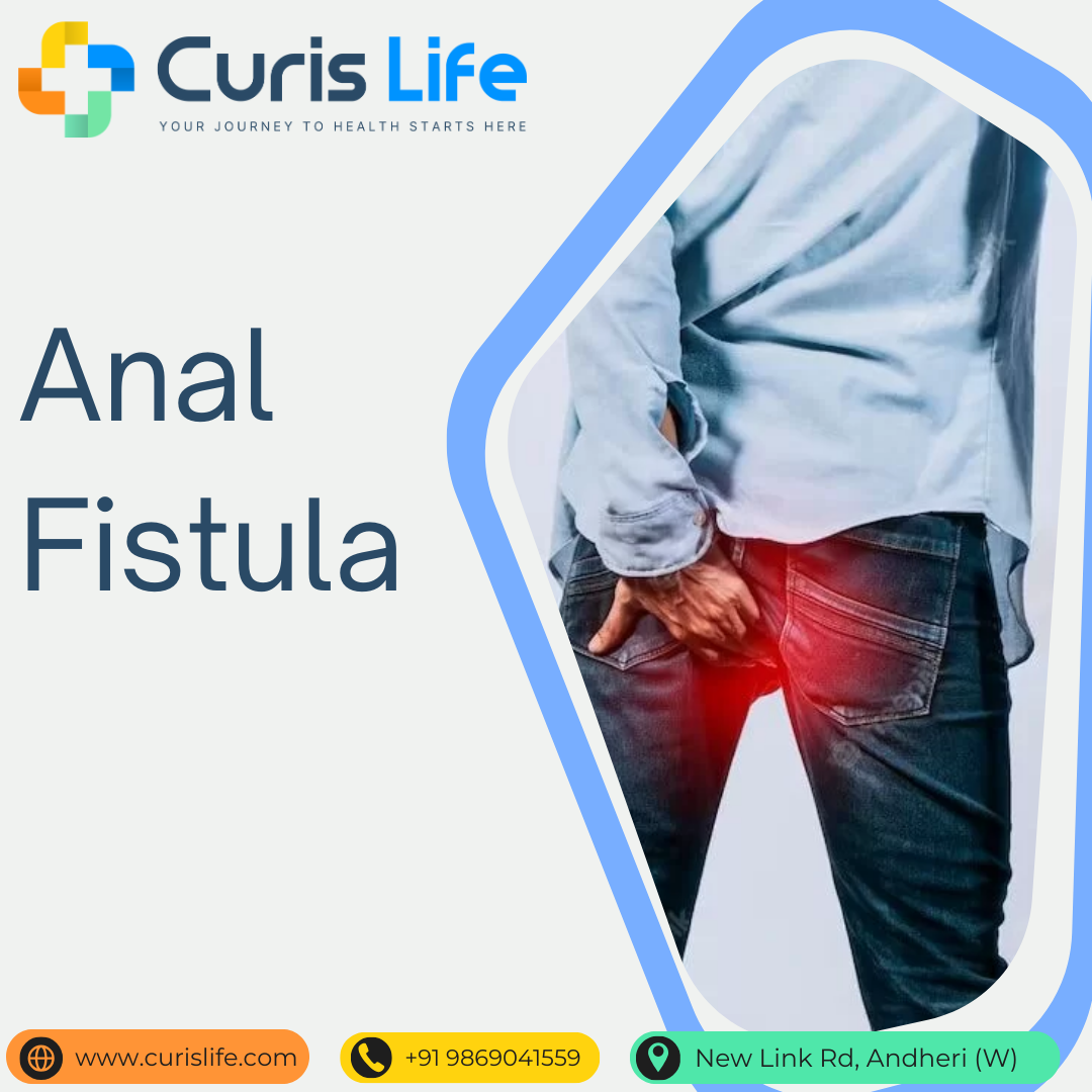 Anal Fistula Surgery in Andheri West | Curis Life Multispecialty Clinic