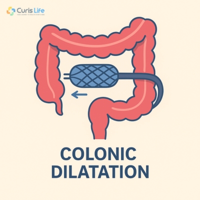 Colonic Dilatation in Andheri West | Curis Life