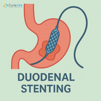 Duodenal Stenting in Andheri West | Curis Life