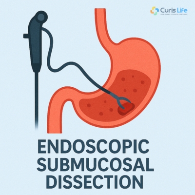 Endoscopic Submucosal Dissection (ESD) in Andheri West | Curis Life