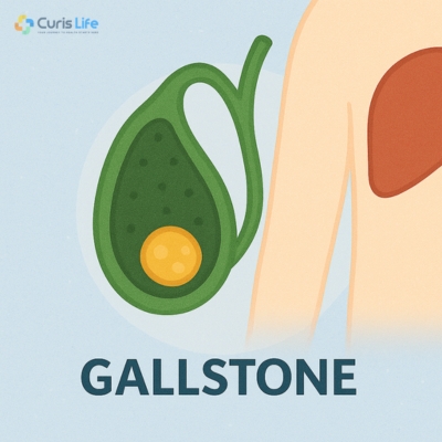 Gallstone Treatment Near Me in Andheri West | Curis Life