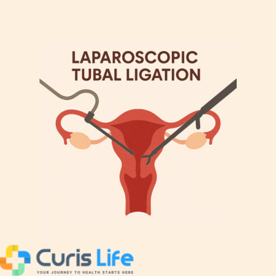 Laparoscopic Tubal Ligation in Andheri West | Curis Life Clinic