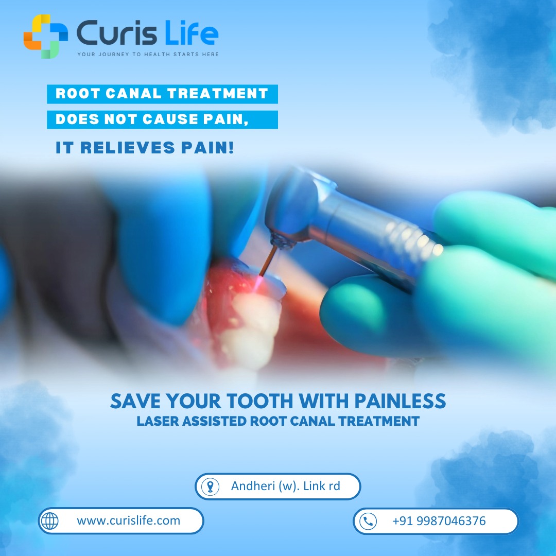Root Canal Treatment (RCT) in Andheri West | Expert Care at Curis Life