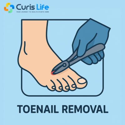 Toenail Removal in Andheri West | Safe & Painless Procedure at Curis Life