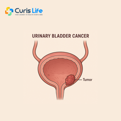 Urinary Bladder Cancer Treatment in Andheri West | Curis Life ...